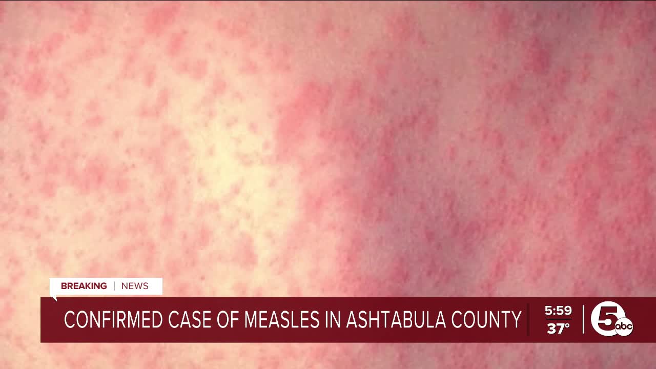 1st 2025 measles case in Ohio reported in Ashtabula County