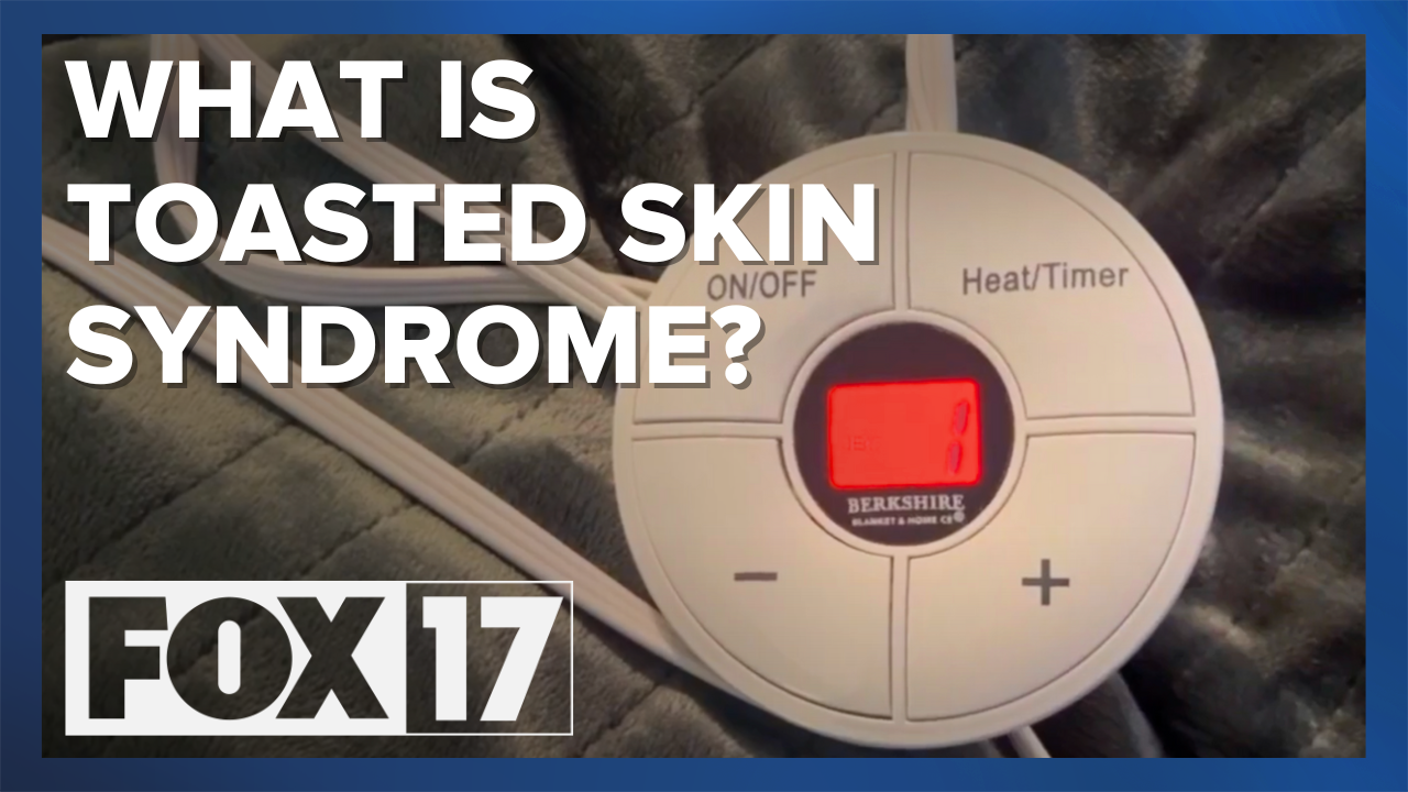 What is "toasted skin syndrome" and what you need to avoid