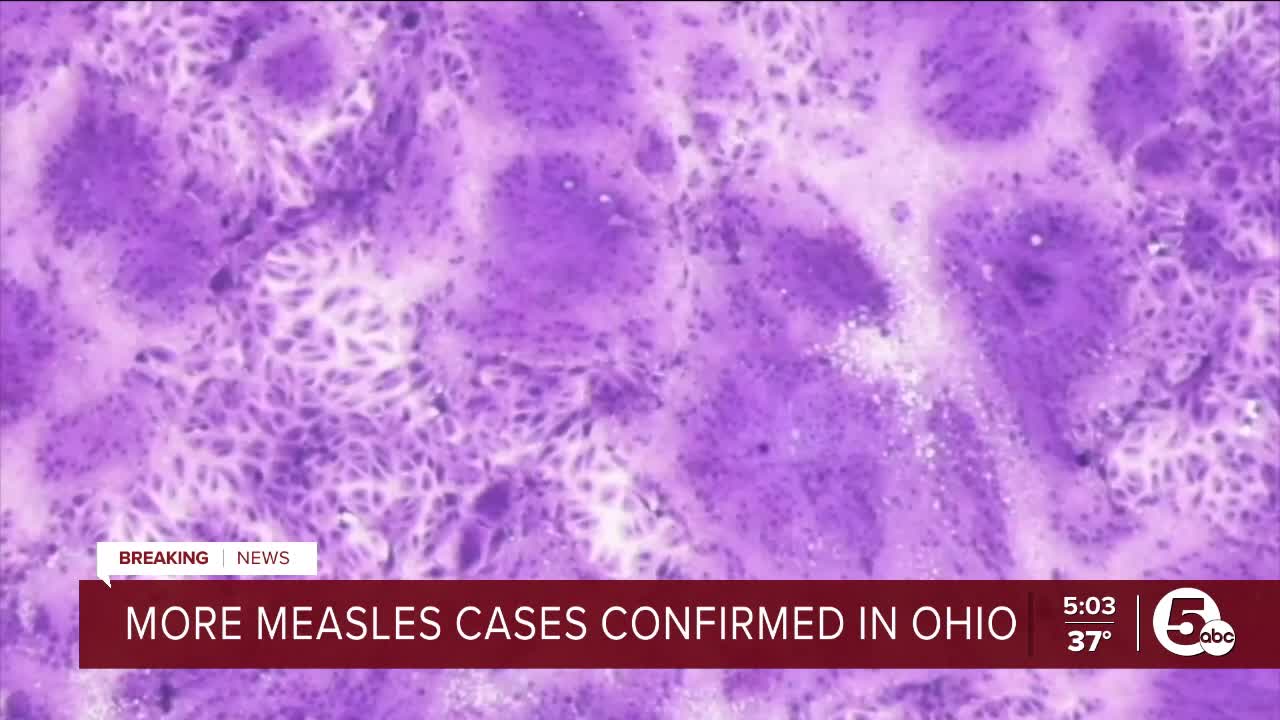 Measles outbreak hits Ohio
